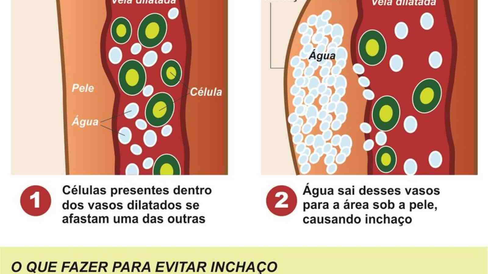 Inchaço nas pernas exige atenção especial - O Nacional